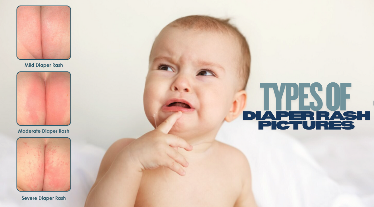 What Does Diaper Rash Look Like? Pictures & Types Guide